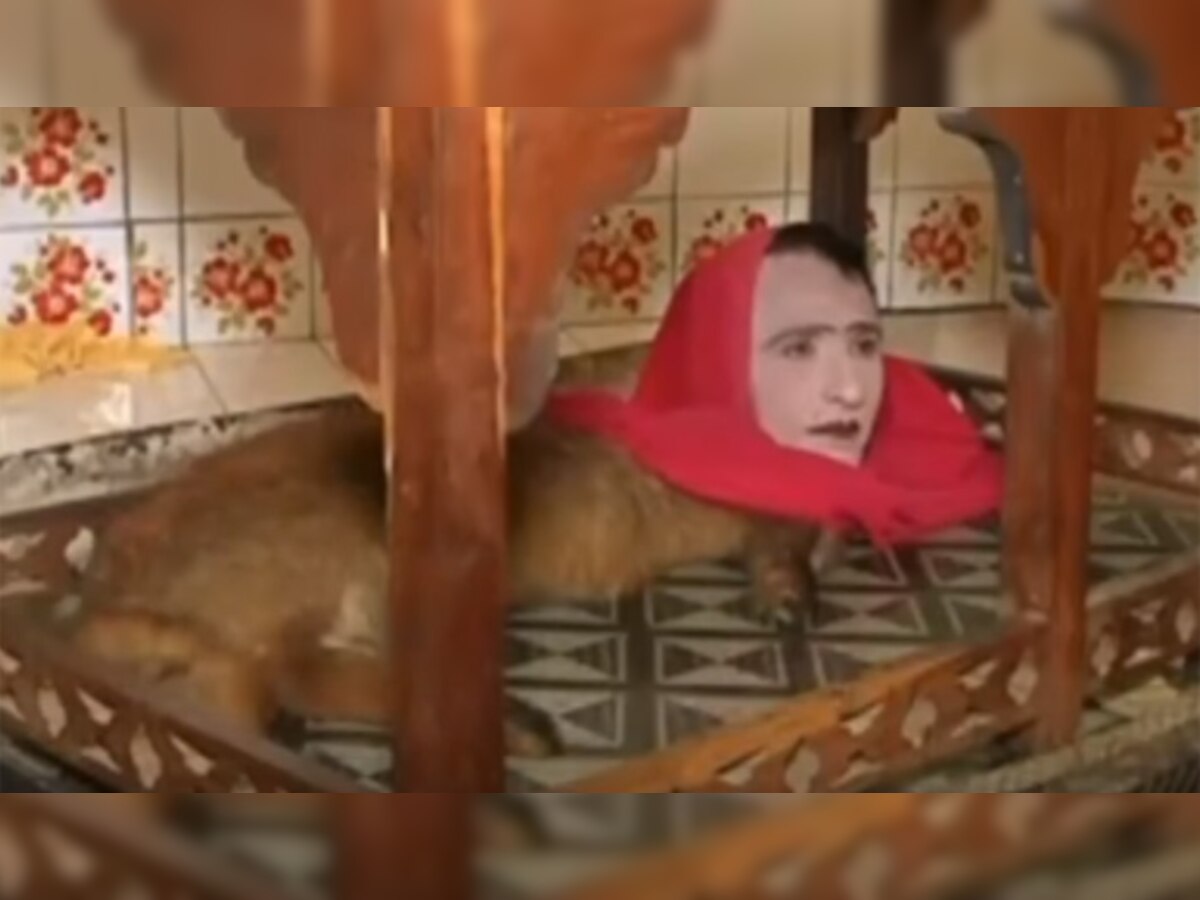 Pakistani girl Half Fox Half Human | अजूबा! एक लड़की का सिर इंसान का और ...