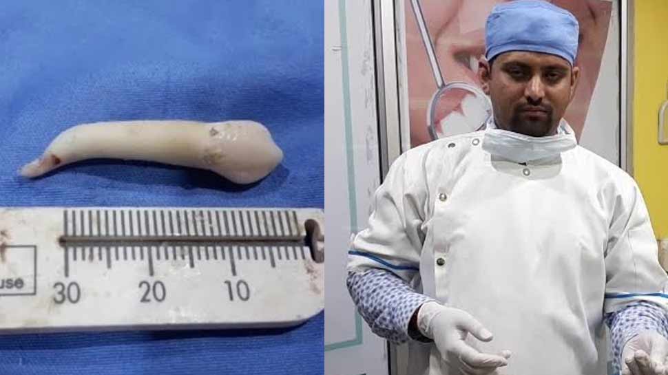 dentist extracts 39 mm long tooth from patient's jaw breaks guinness ...