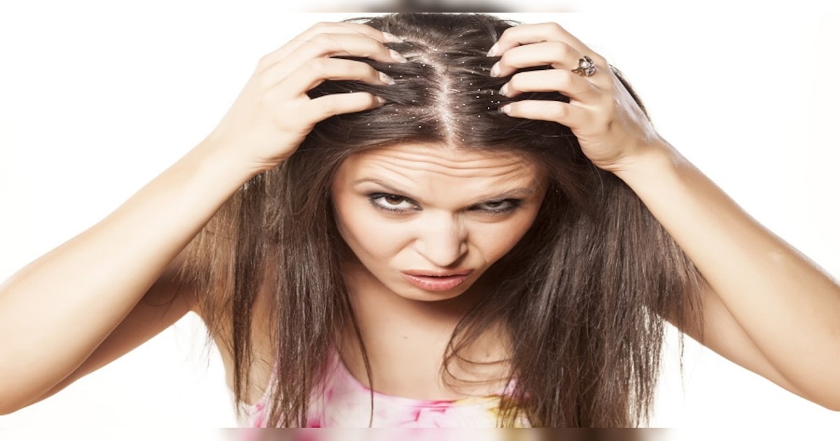 HOW TO SOLVE DANDRUFF AND HAIRFALL PROBLEMS WITH HOME REMIDIES ...