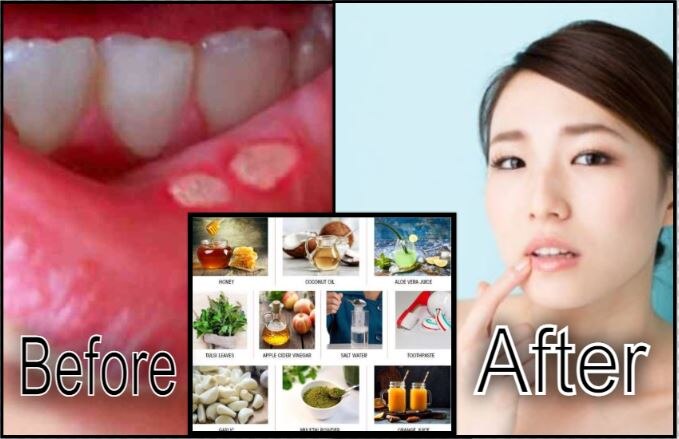 know how to get rid from alsar by the use of home remedies | घरेलू ...