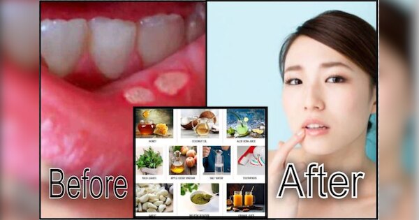 know how to get rid from alsar by the use of home remedies | घरेलू उपचार से पाएं मुंह के छाले से ...