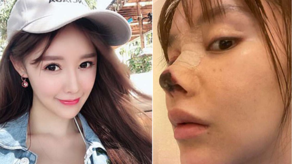 Chinese singer Gao Liu went through nose surgery shocking pictures ...