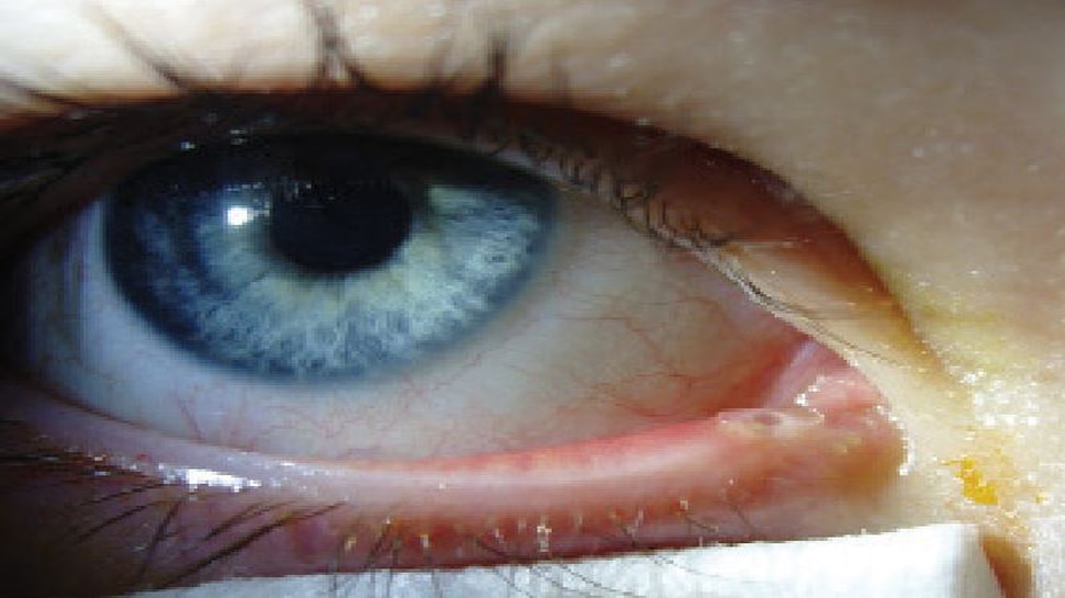 know about lacrimal Punctum, a part of our eyes | Lacrimal Punctum ...