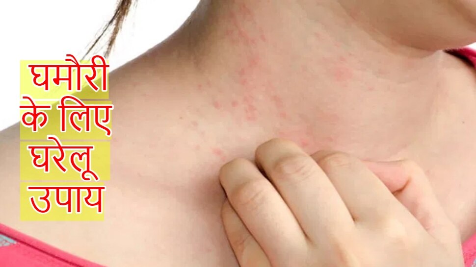 home remedies for summer itching and heat rash | Heat Rash Remedies ...