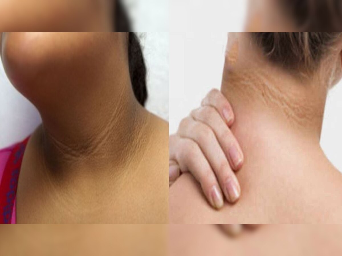 These home remedies is very beneficial for away blackness of neck know ...
