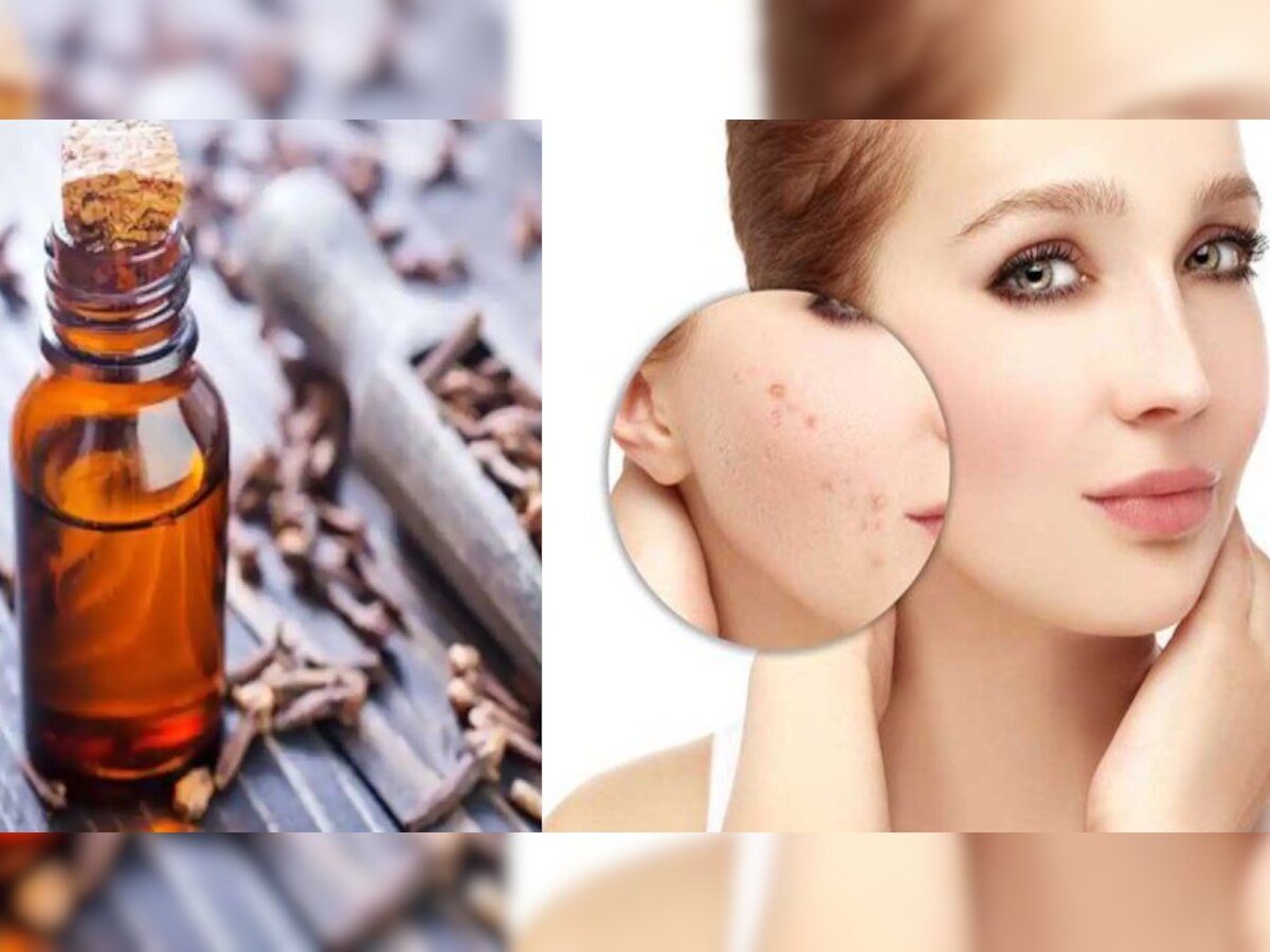 Clove is beneficial in removing facial scars know here Make your face ...