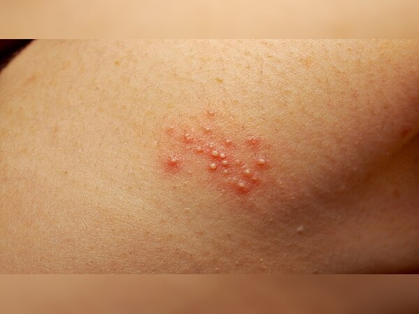 how to treat prickly heat at home janiye garmi me ghamori hatane ka ...