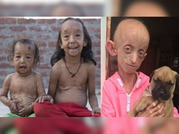 rare benjamin button disease progeria syndrome cause rapid aging in ...