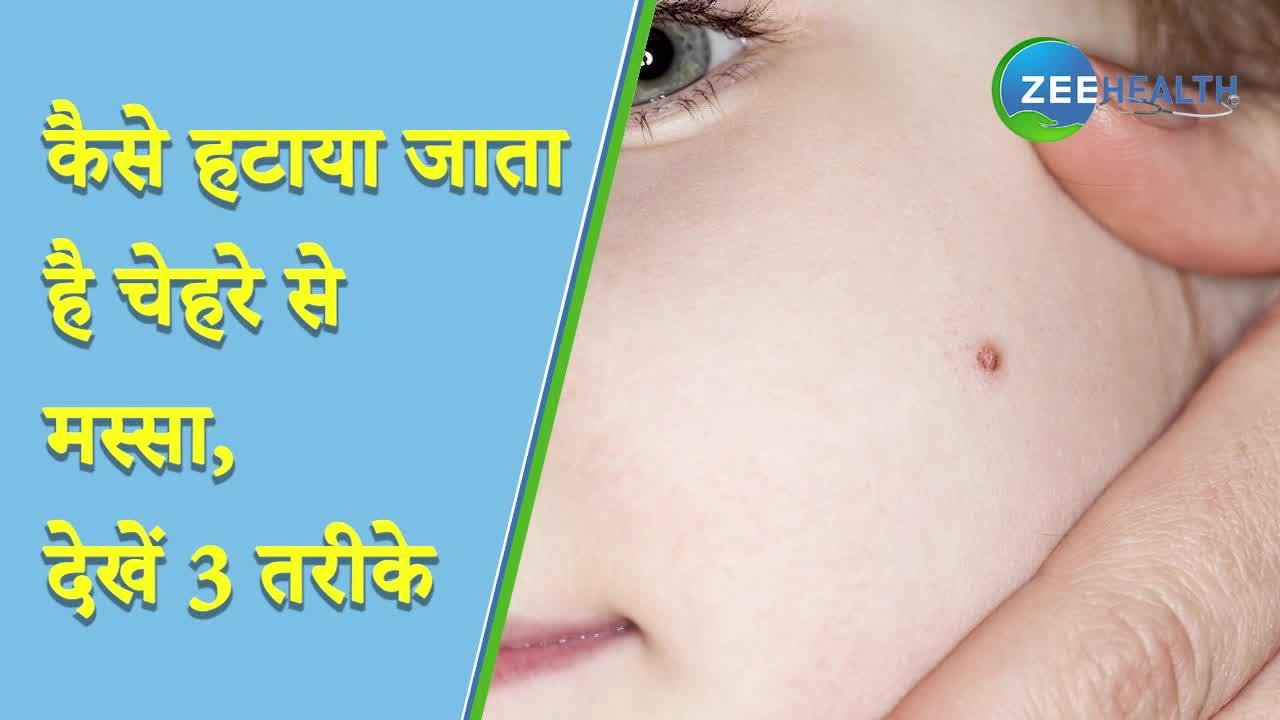 how to remove wart from face see video here samp | कैसे हटाया जाता है ...