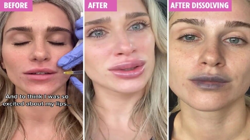 Beauty Disaster: सुंदर दिखने की चाह में टिकटॉक यूजर ने किया ये काम, बाद ...