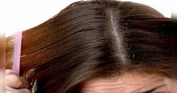 hair care tips reason of hair fall dandruff problem | जानिए क्यों होती ...