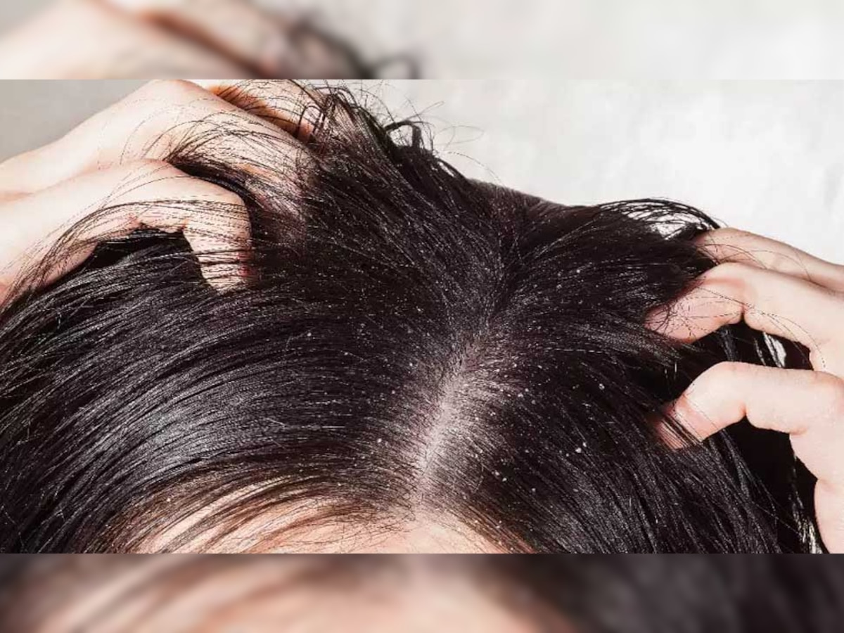 hair care tips reason of hair fall dandruff problem | जानिए क्यों होती ...