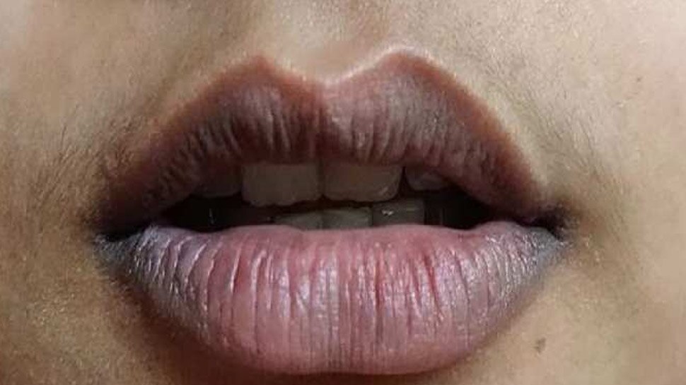 How to lighten dark lips cause of lips hyperpigmentation | Lighten Dark ...