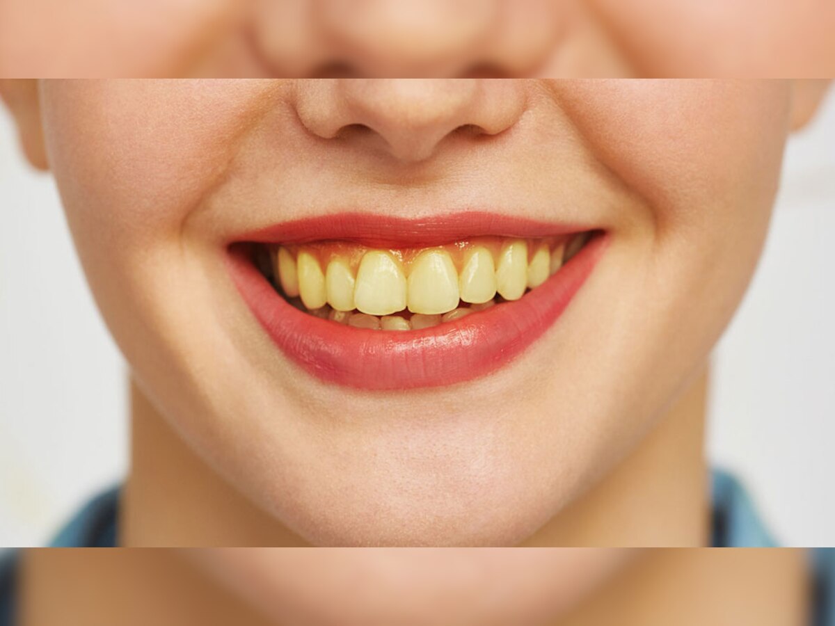 How to cure Yellow Teeth Clove Apple Cider Vinegar Mustard oil Salt ...