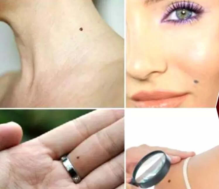 mole on human body know meaning and effect and future til ka matlab ...