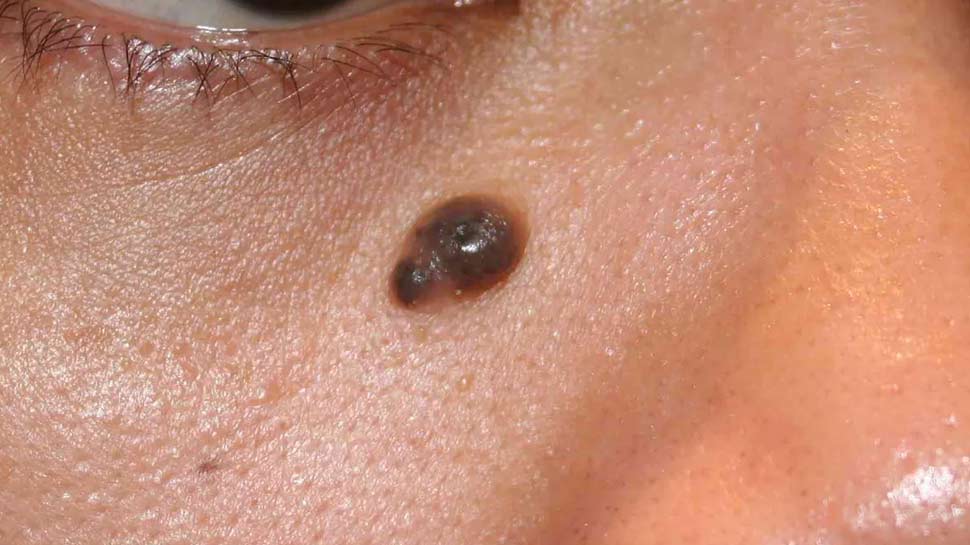 How to Remove Mole at Home using Castor Oil with Ginger Baking Soda Tea ...