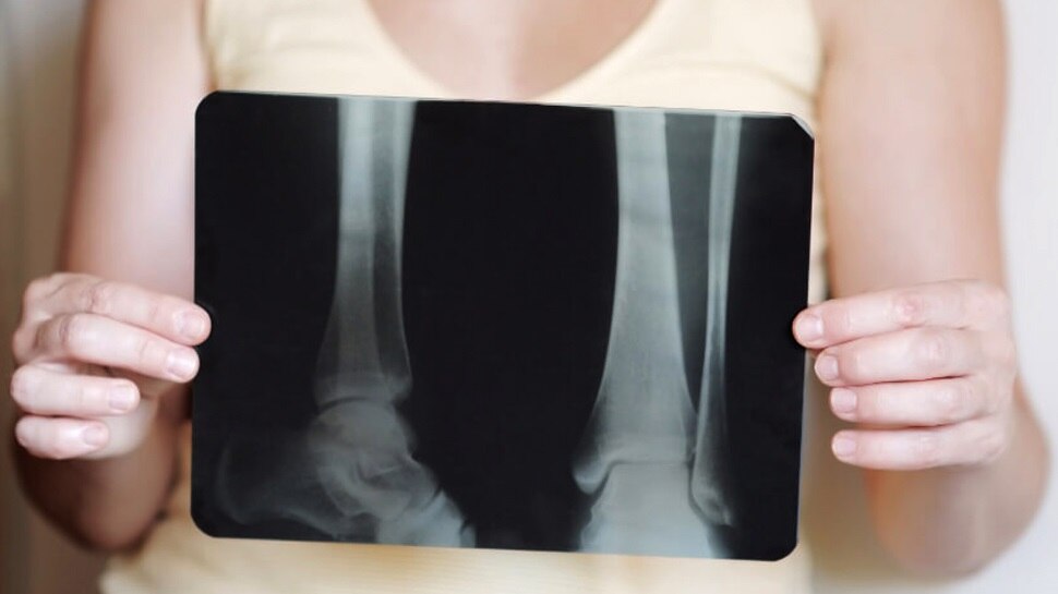 these five bad habits may causes of bone weakness of human being ...