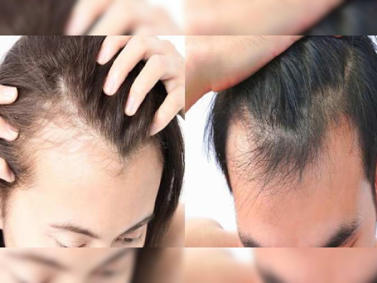 Hair fall problem cause of hair loss treatment how to reduce hair fall ...