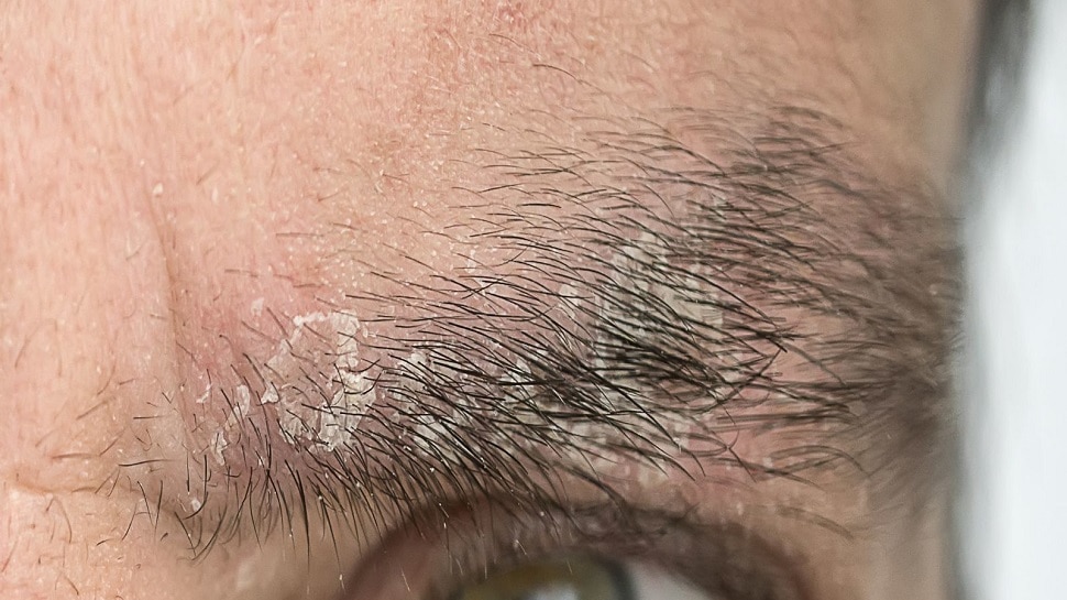 eyebrow dandruff symptoms and causes know how to remove dandruff from ...