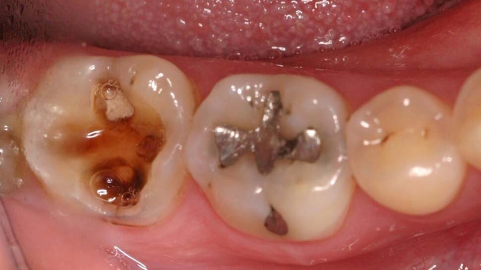 Are you troubled by insects in your teeth use these things which is in ...