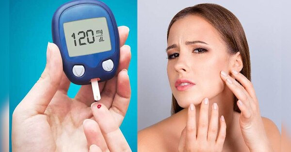 Type 2 Diabetes Warning Sign on Face Early Symptoms Colour Change Dry ...