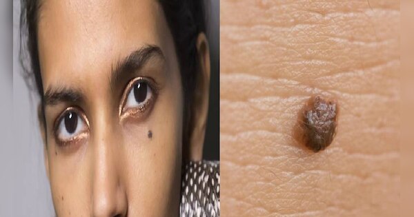 mole and massa removal skin for easy tips know how to remove wart massa ...