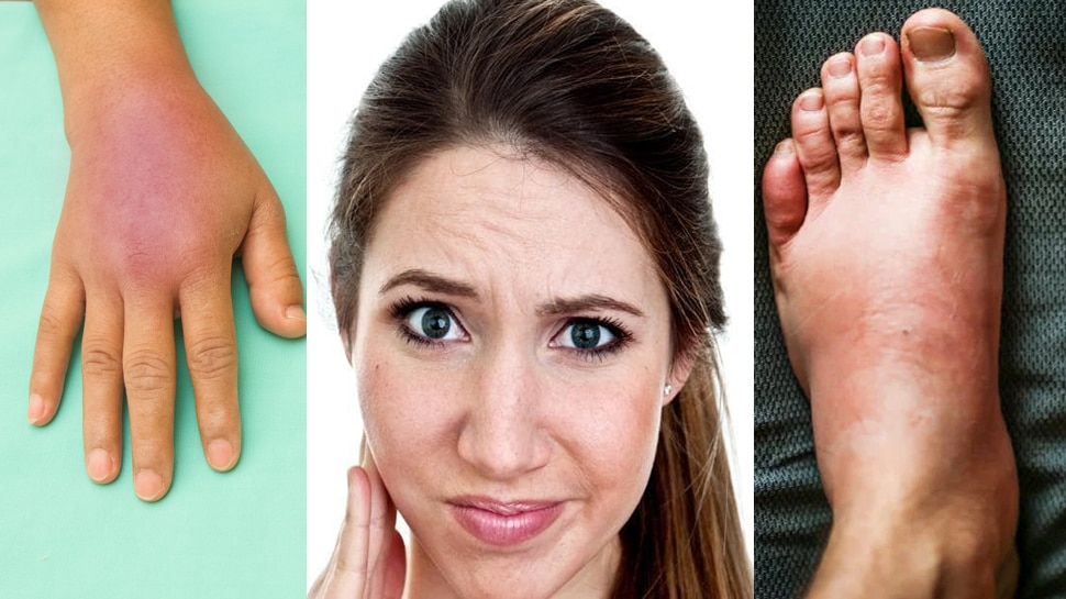 Swelling On Body Face Leg and Hand Reason is Thee Disease Heart Liver ...