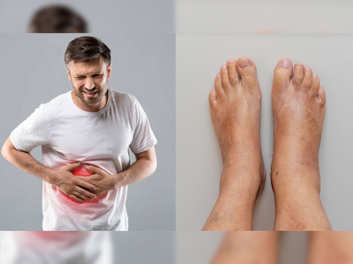 Swelling On Body Face Leg and Hand Reason is Thee Disease Heart Liver ...