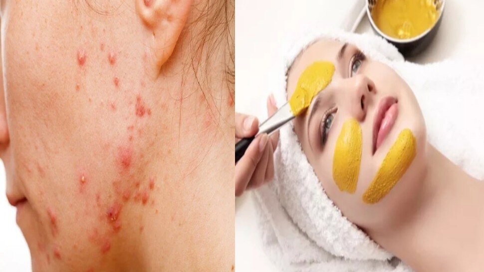 know how to remove skin pimple in barsat monsoon rainy season with this ...