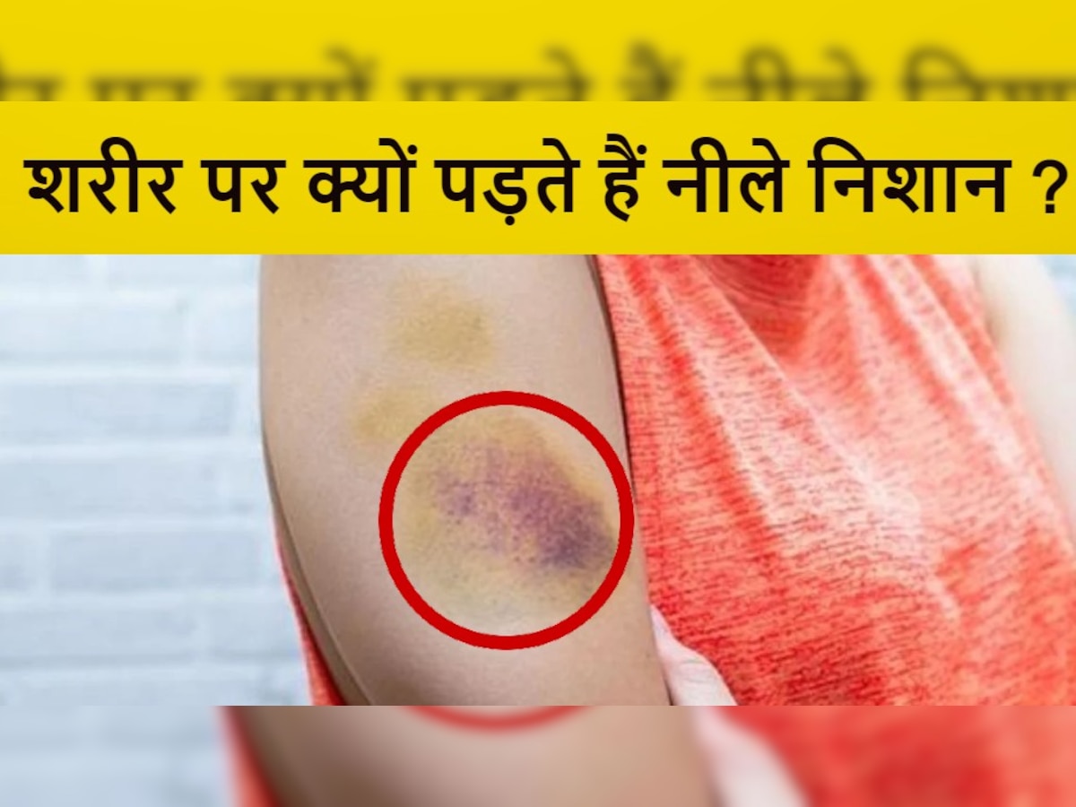 know how to Blue Scar occured on skin body pr neele nishan mkph | Blue ...