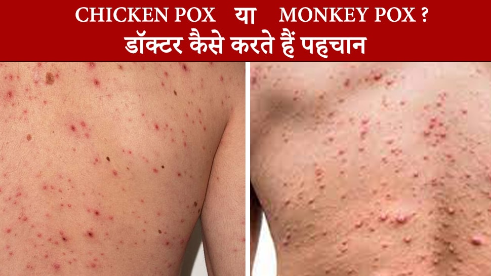 6 difference between monkeypox virus and chickenpox virus on which ...