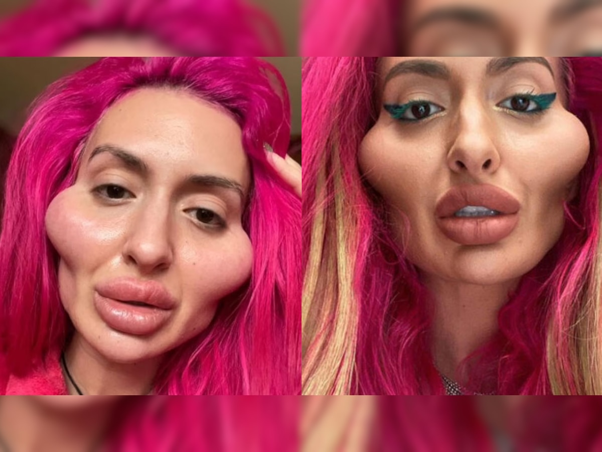 World Biggest Cheeks of Anastasia Pokreshchuk Netizens Shocked After ...