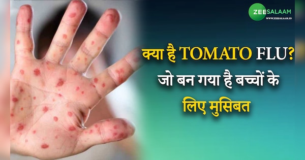 What is Tomato flu spreading in India, symptoms, precautions, corona ...