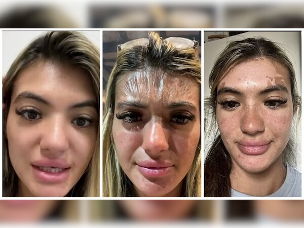 British woman forehead burn after falling asleep in 70F sun in Bulgaria ...