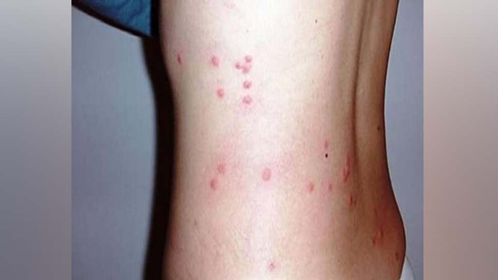 health news symptoms and prevention of scrub typhus disease fiver health department alert mpap ...