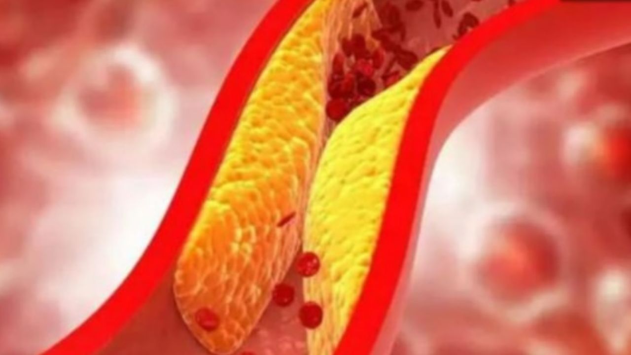 Increasing amount of triglycerides is dangerous for the heart ...