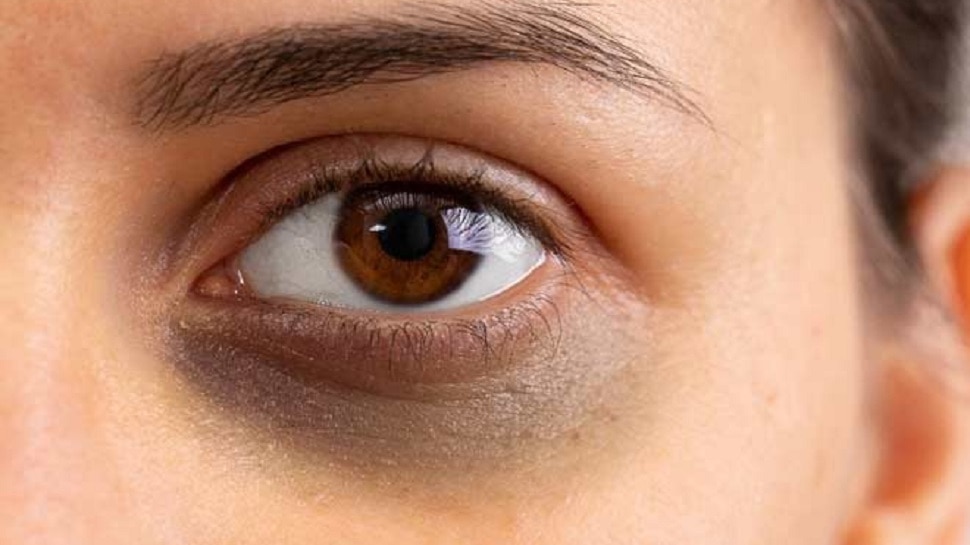 Dark Circles Home Remedies Try These Method To Get Rid Of Dark Circles