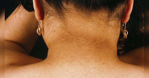 Dark neck treatment in Hindi and its causes remove black neck From home ...