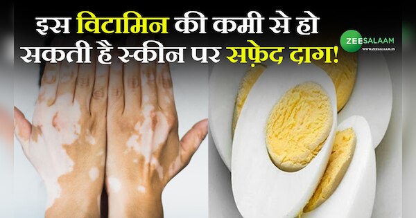 White spots Deficiency of this vitamin can cause white spots on the ...