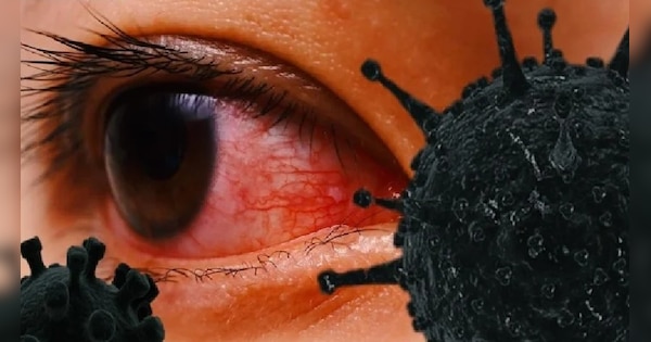 why eyes are removed in black fungus disease know symptoms nsmp | Black ...
