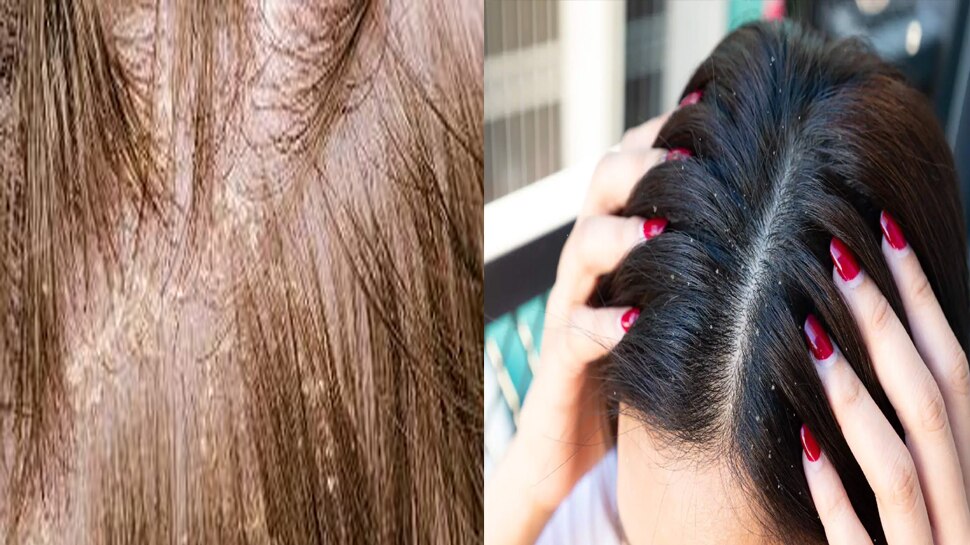 Dandruff treatment in hindi know home remedies SMI | Dandruff treatment ...