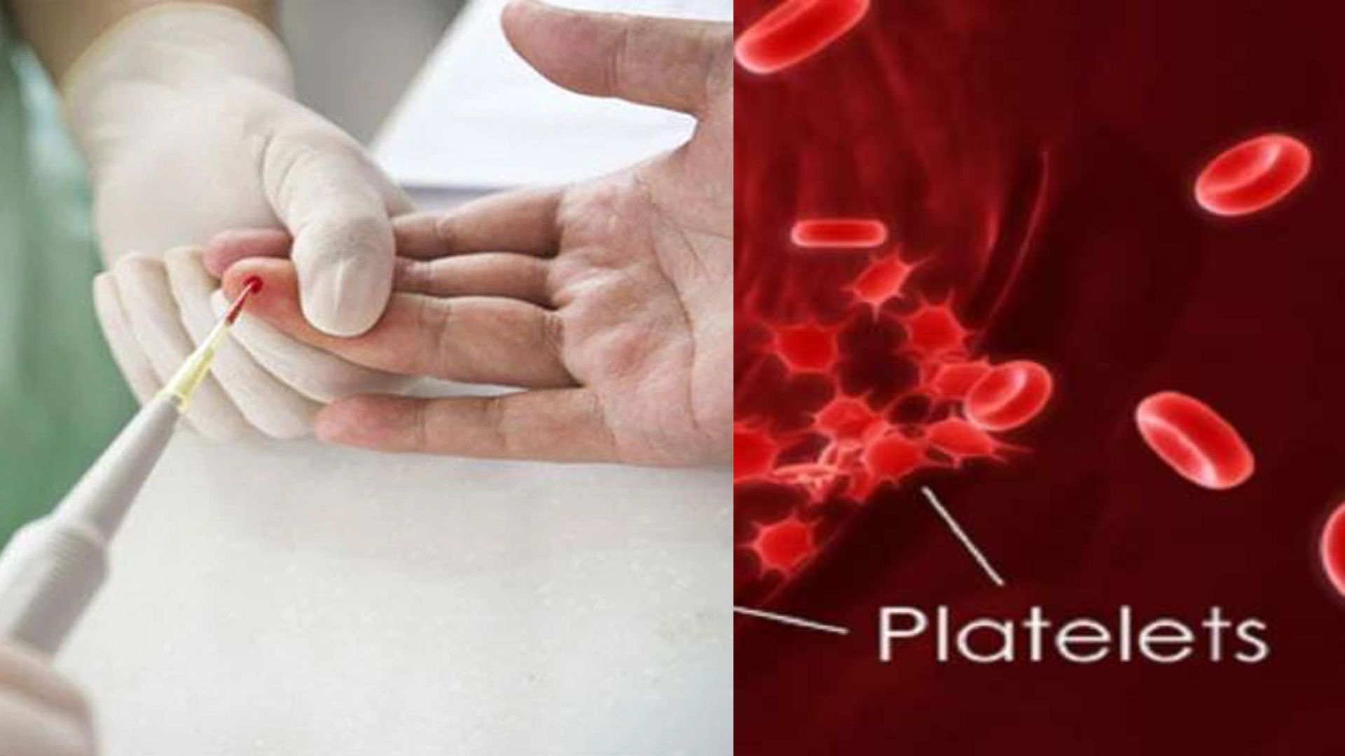 dengue platelets fall in these diseases do not ignore them Anemia Hepatitis C Viral Cancer ...