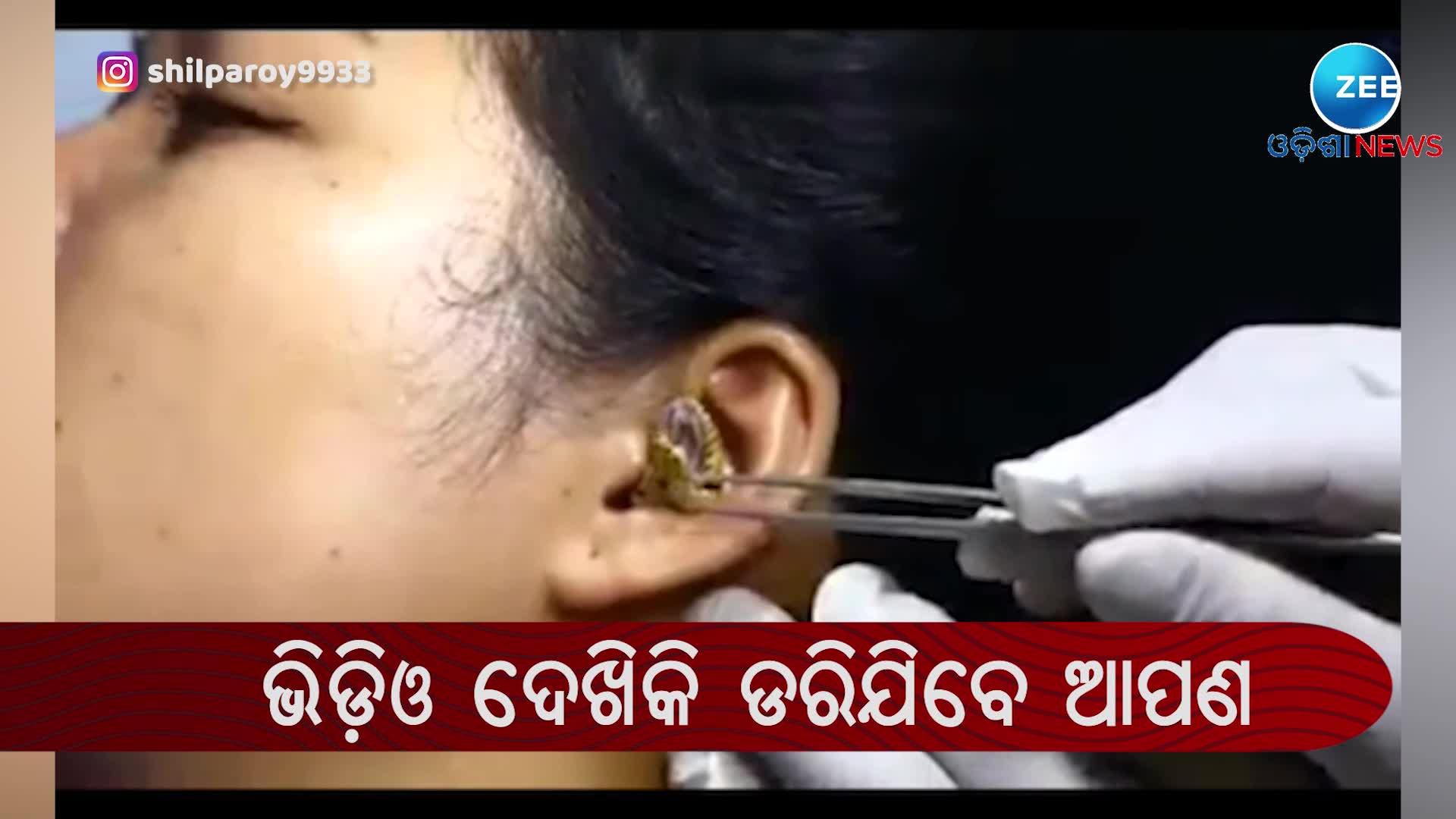 Snake Enters Inside woman's ear; rare video goes viral | ମହିଳାଙ୍କ କାନ ...