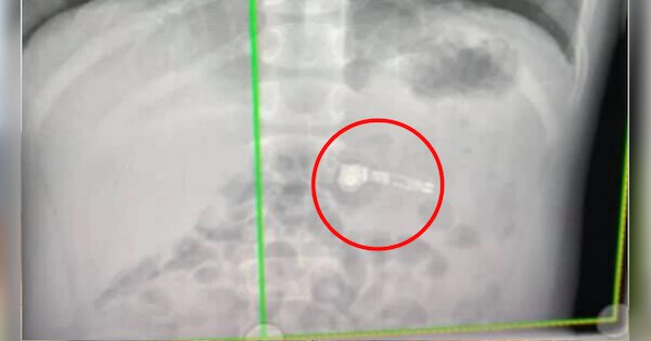 girl ate Apple iPod thinking it as a medicine Doctor shock after seeing ...