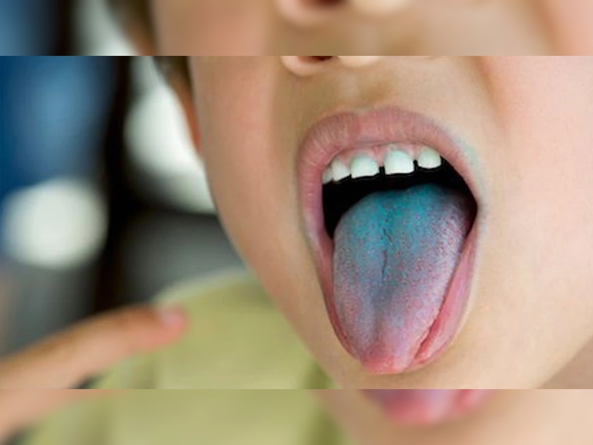 change in tongue colour means it can be symptoms Of disease | Tongue ...