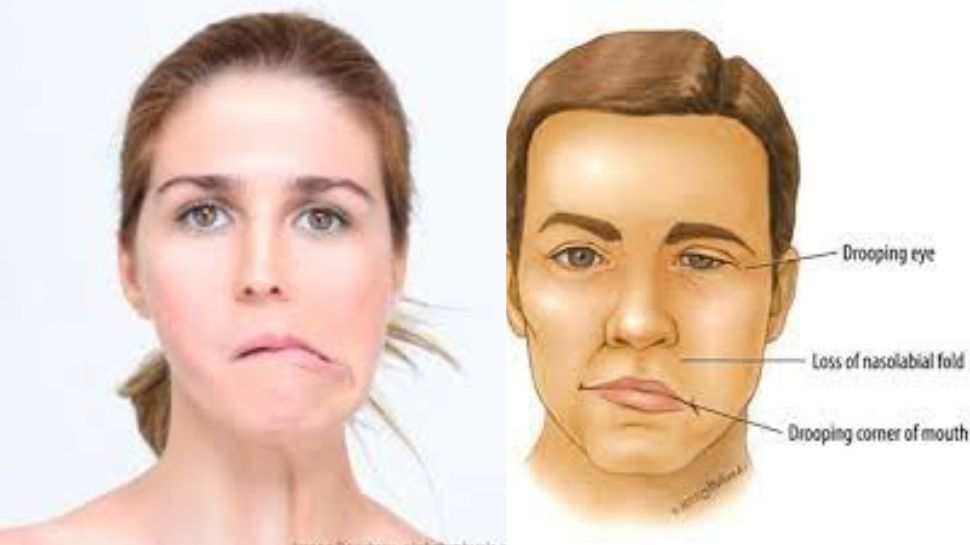health tips on Bells palsy disease | सर्दियों में क्यों बढ़ता है फेशियल ...