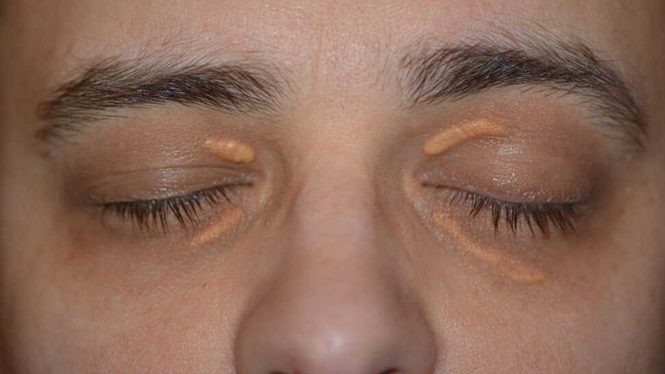 Diabetes Symptom Warning Signs On Skin Harness Infection Mouth Ulcer ...