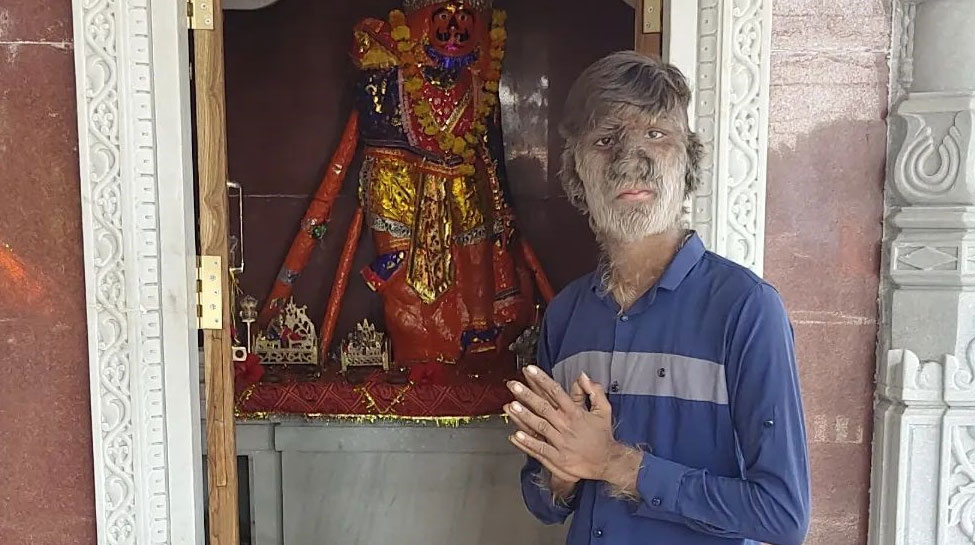 lalit patidar has werewolf syndrome madhya pradesh news viral news ...