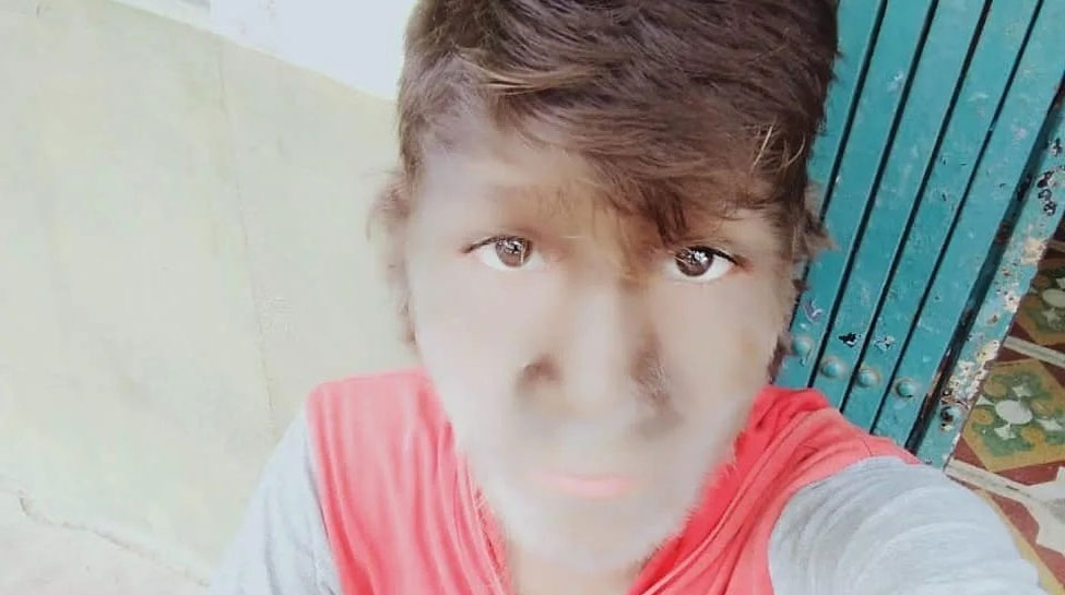 lalit patidar has werewolf syndrome madhya pradesh news viral news ...