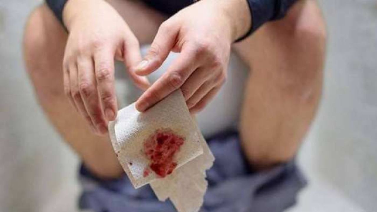 Piles Or Hemorrhoids Will Go Away Without Surgery Follow This Home
